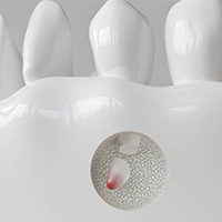 What is an Apicoectomy? Everything You Need to Know About Root-End ...